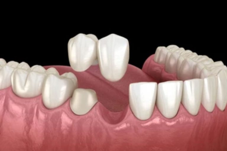 Should You Choose a Dental Bridge for Tooth Loss?